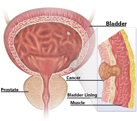 Bladder Cancer: Overview and Treatment Options – my.DrugGenius