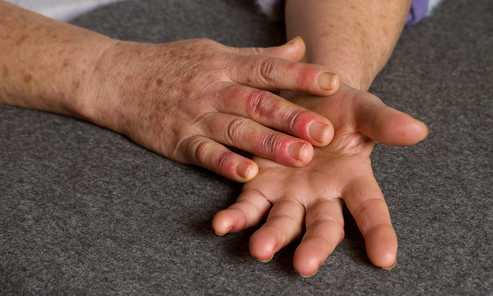 Relieve Raynaud’s Disease With These 10 Treatments – my.DrugGenius