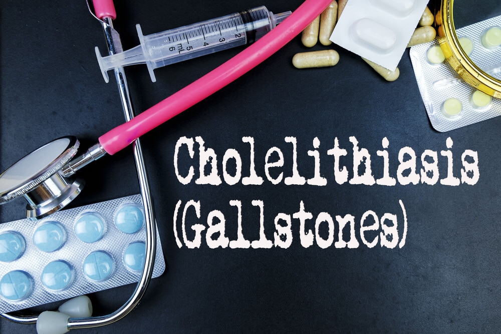13 Gallstone Treatment Options to Try Now – my.DrugGenius